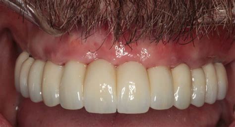 Upper Fixed Implant Bridges Immediate Fixed Temporary Bridge