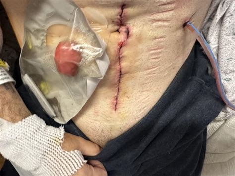 I Had A Closed Loop Small Bowel Obstruction Due To Scar Tissue And This