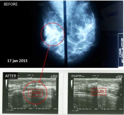 Cancer Treatment For Invasive Ductal Carcinoma Breast Cancer