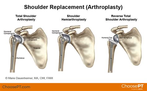 Dos And Donts For Shoulder Arthroplasty Surgery Results Shoulder Clinic Hyderabad