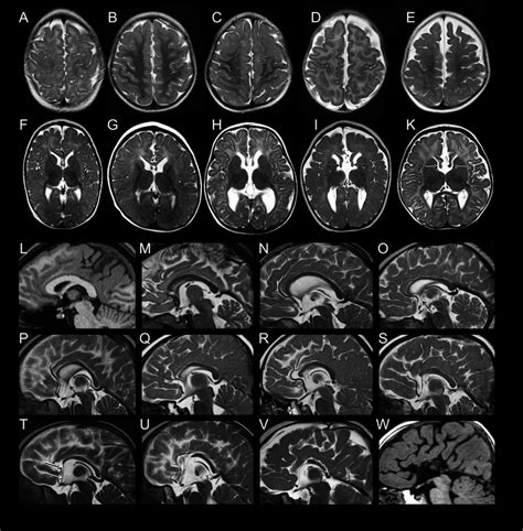 Spectrum Of Structural Brain Anomalies In Foxg1 Syndrome Revealed By Download Scientific