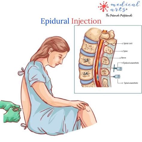 Epidural Injection Epidural Anesthesia Medical Arts Shop