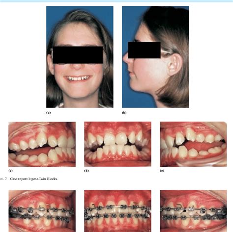 Figure 6 From The Modified Twin Block Appliance In The Treatment Of Class Ii Division 2