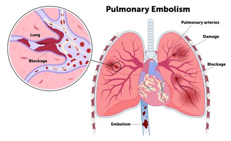 Pulmonary Embolism Guideline Comparison Key Points Cardio Blogger