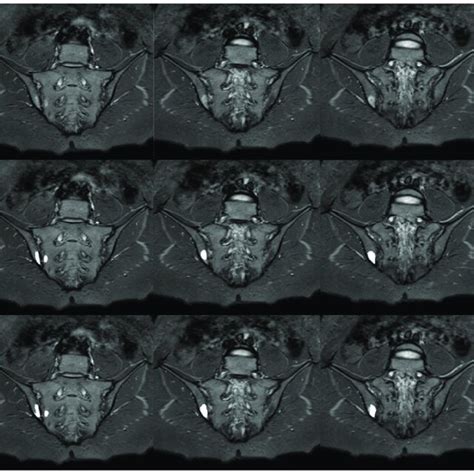 Sample Slices With Inflammatory Lesions Sparcc 17 Stir Sequence In Download Scientific