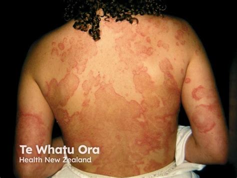 Urticaria And Urticaria Like Conditions