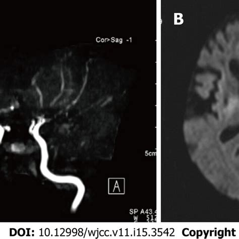 Magnetic Resonance Angiography And Diffusion Weighted Magnetic Download Scientific Diagram