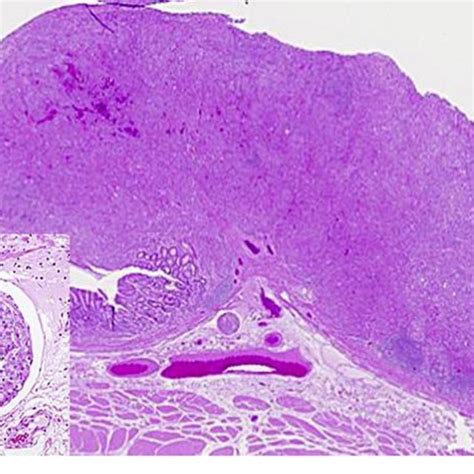 Case 1 Showed A Polypoid Solid Intramucosal Lesion Submucosal Download Scientific Diagram