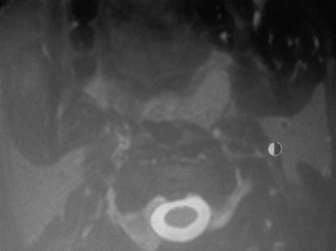 Tonsillar Mass Mri Sumers Radiology Blog