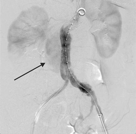 Following Angiogram Showed A Significant Amount Of Type I Endoleak