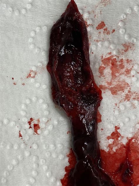 Fibroid Degeneration R Fibroids