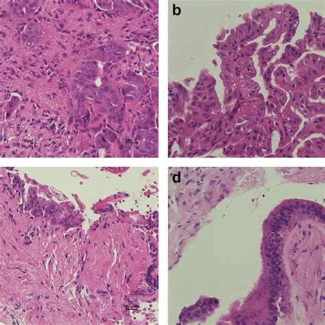 A Case Diagnosed As Perihilar Cholangiocarcinoma With Download