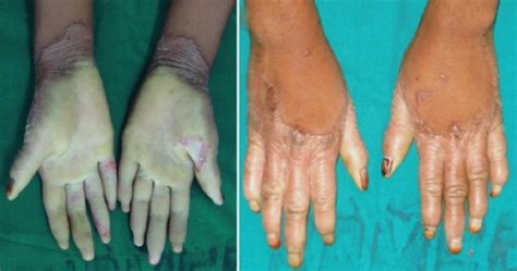 Transgradient Palmoplantar Keratoderma With Sharp Margi Open I