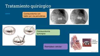 Medicina Interna Valvulopatías Pdf
