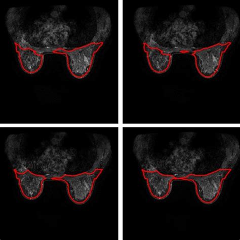 Breast Segmentation With Tumours Case 2 Download Scientific Diagram
