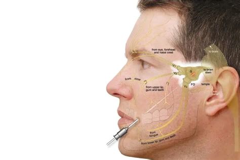 Trigeminal Nerve Ablation Red Butte Pain Solutions