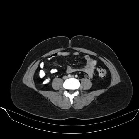 Radiopaedia Case Duplicated Renal Collecting System With Ectopic Ureter
