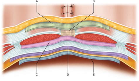 Abdominal Wall Spaces For Mesh Placement Onlay Sublay Underlay