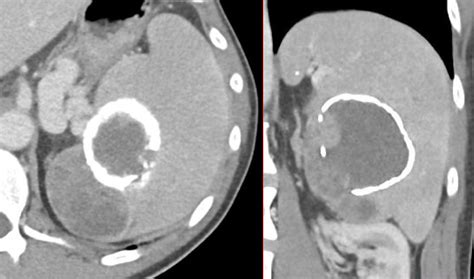 Gastrointestinal Learning Modules Ct Scanning