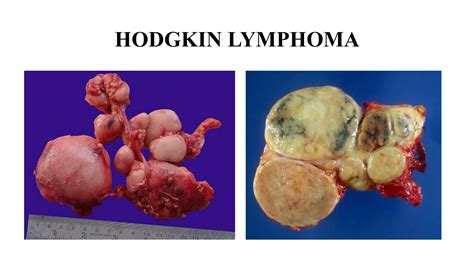 Meghana Neoplastic Lesions Of Lymph Node Part 1 Ppt