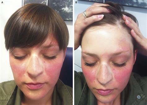 Phototoxic Dermatitis New England Journal Of Medicine