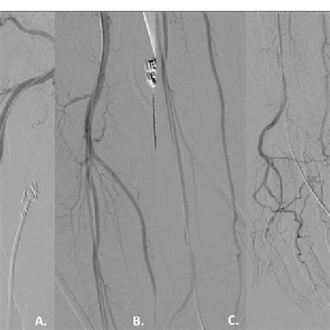 Radial Artery Spasm Picture 6 A B In The Proximal Part Of The Radial