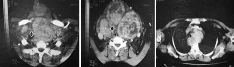 Multinodular Goiter Pathogenesis And Management Oncohema Key