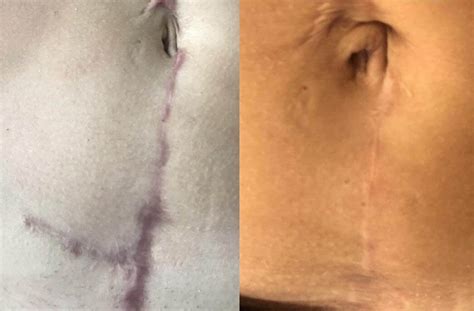 Why Does My C Section Scar Itch Years Later