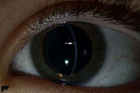 Congenital Hereditary Endothelial Dystrophy