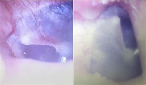 The Difference Between A Normal Eardrum And A V2k Eardrum Picture 1 Normal Pictures 2 3 4 With