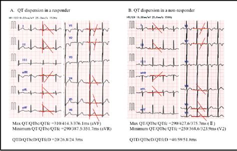 Figure 1 From Prognostic Significance Of Qt Interval Dispersion In The Response To Intravenous