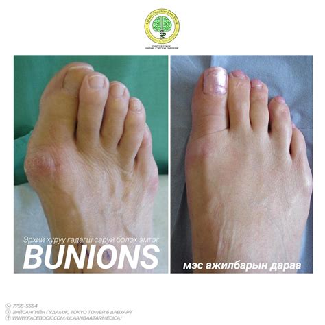 Эрхий хурууний 2 р үеийн хэлбэр алдагдах эмгэг 💎Бариу гутал өмсөх 💎Өсгийтэй гутал удаан өмсөх 💎