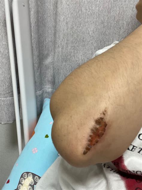 찰과상 조금 징그러워요 지식in