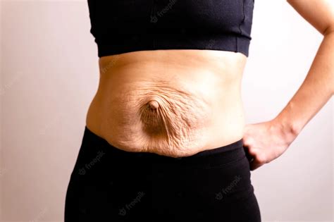 How To Identifie Stretch Marks Symptoms Healthtopical