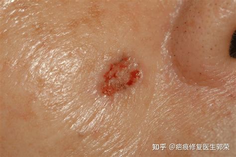 疤痕疙瘩破溃流脓怎么办一定要引起注意 知乎