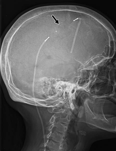 Hydrocephalus Shunt Mri