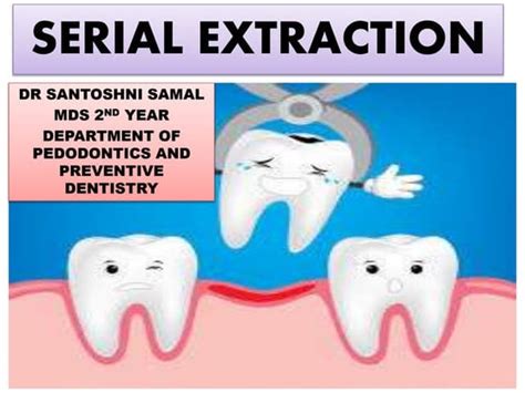 Dewel`s Method Of Serial Extraction Interceptive Orthodonticspptx
