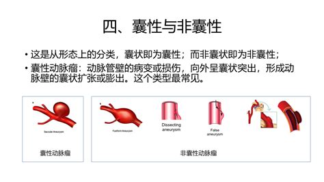 颅内动脉瘤的类型知多少？ 脑医汇