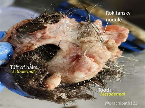 Ovarian Teratoma Pathology Made Simple