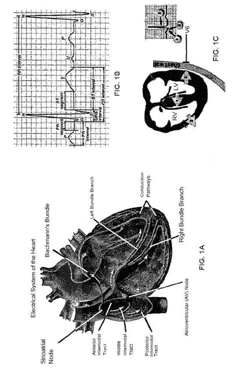 Annuloplasty Procedures Related Devices And Methods Eureka Patsnap