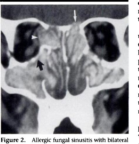 Figure 1 From Allergic Fungal Sinusitis Ct Findings 1 Semantic Scholar
