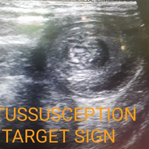 Ultrasound Imaging Showing Loop Within Loop Picture Target Sign Download Scientific Diagram