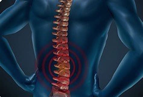 Pivd Prolapsed Intervertebral Disc Physio Heal Well