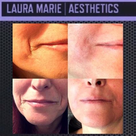 Botox Marionette Lines Before And After 4 Facial Injections Info Prices Photos Reviews Qanda