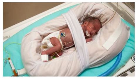 Molnlycke Healthcare Us Llc Moldable Positioner Z Flo Neonatal Squar