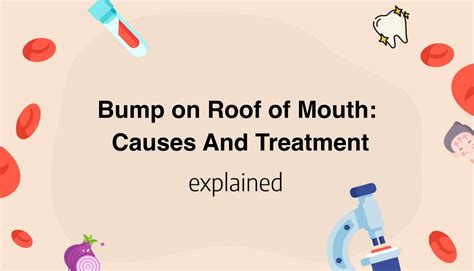 Bump On Roof Of Mouth Causes And Treatment