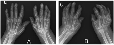 Rheumatoid Arthritis Hands X Ray
