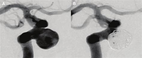 Angiography Findings Before And After Embolization Of The Right Ica Download Scientific