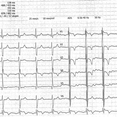 An Electrocardiogram Sinus Rhythm Left Axis Deviation Left Anterior Download Scientific