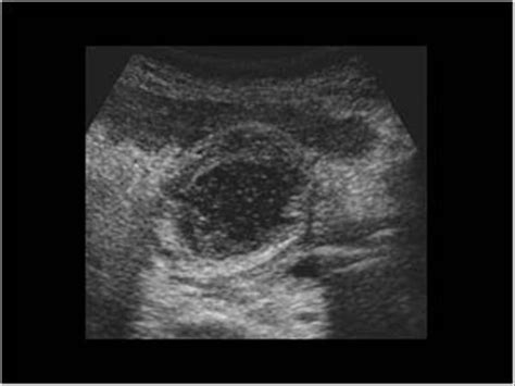 Abdomen And Retroperitoneum 1 2 Gallbladder And Bile Ducts Case 1 2 8 Gallbladder Abscess